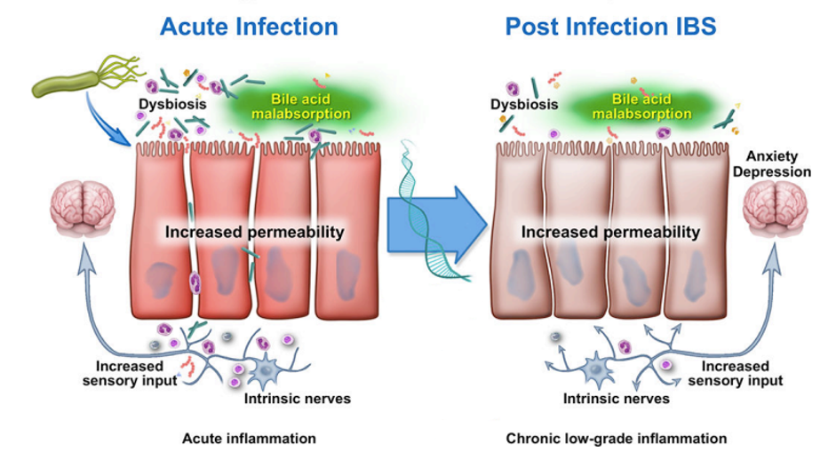 Post Infectious IBS IBS After Food Poisoning