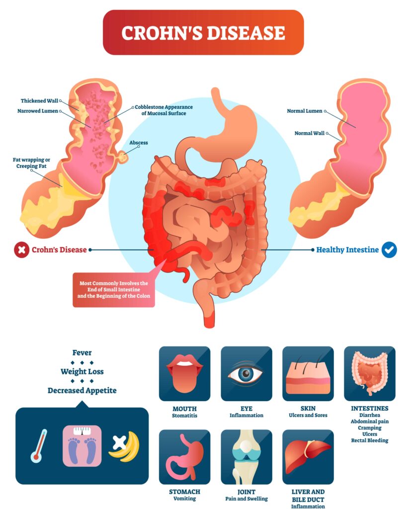 How Is Crohn s Disease Diagnosed The IBS Gut Health Clinic