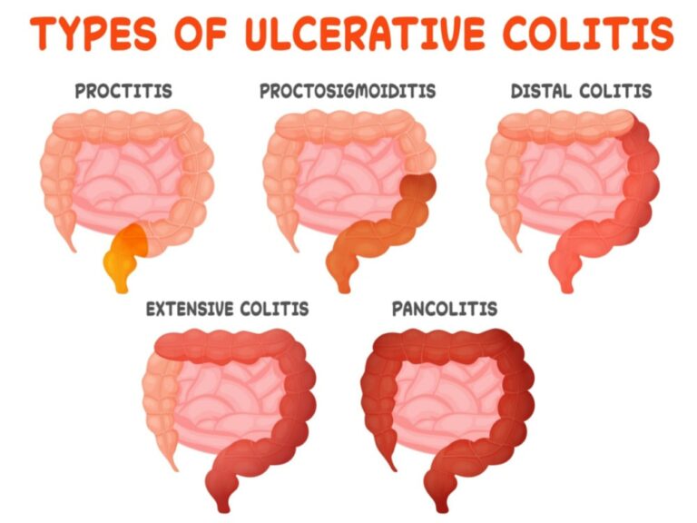 What is Ulcerative Colitis? | The IBS & Gut Health Clinic