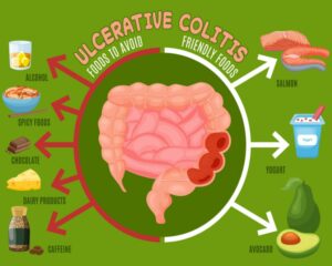 What is Ulcerative Colitis? | The IBS & Gut Health Clinic