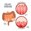 Foods to Avoid if You Suffer With Coeliac Disease