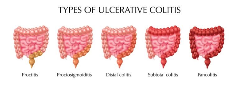 What is Pancolitis? Symptoms, Causes & Treatment