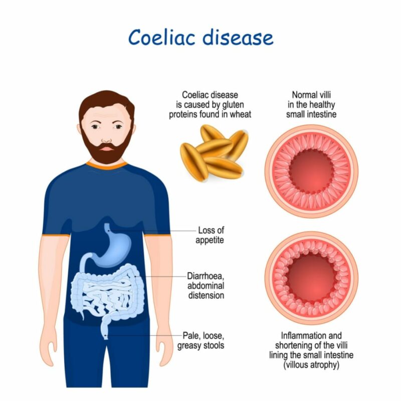 What Is Coeliac Disease? | The IBS & Gut Health Clinic