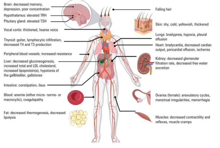 Hashimoto's Thyroiditis Symptoms | The IBS & Gut Health Clinic