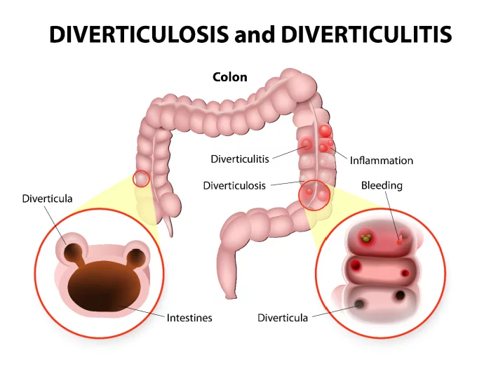 Restricting Nuts Popcorn And Corn In Diverticular Diverticulitis Diet
